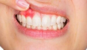 Understanding Pyorrhea: Causes, Symptoms, and Treatment
