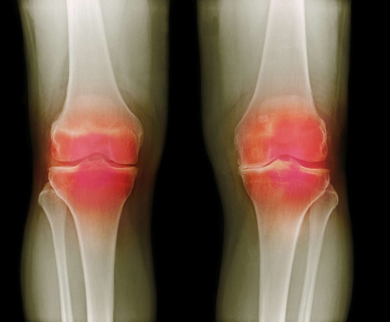 Understanding Knee Pain: Causes, Symptoms, and Treatment
